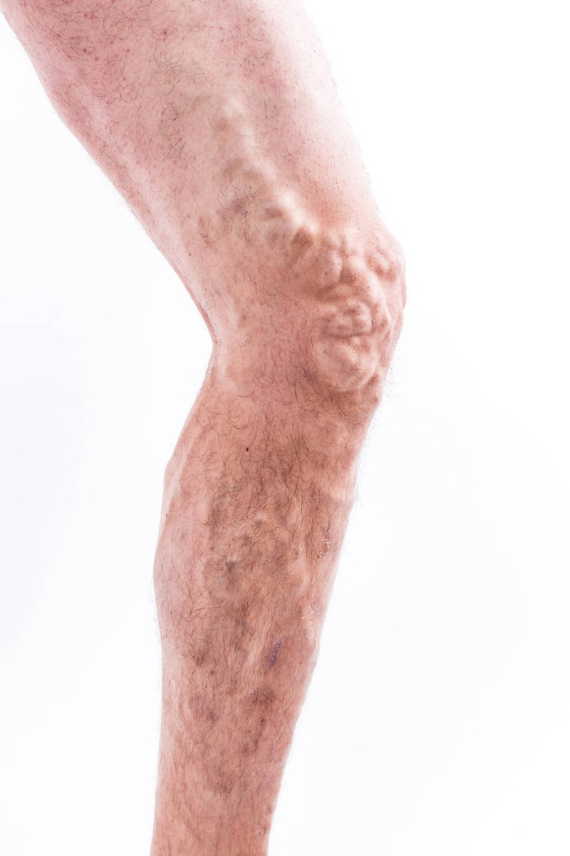 Varicose Veins